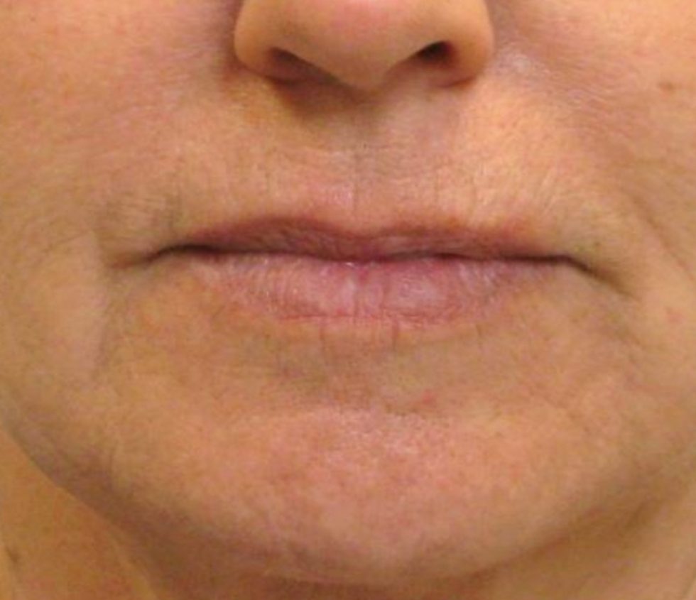 Before and After - Renewed Radiance Med Spa